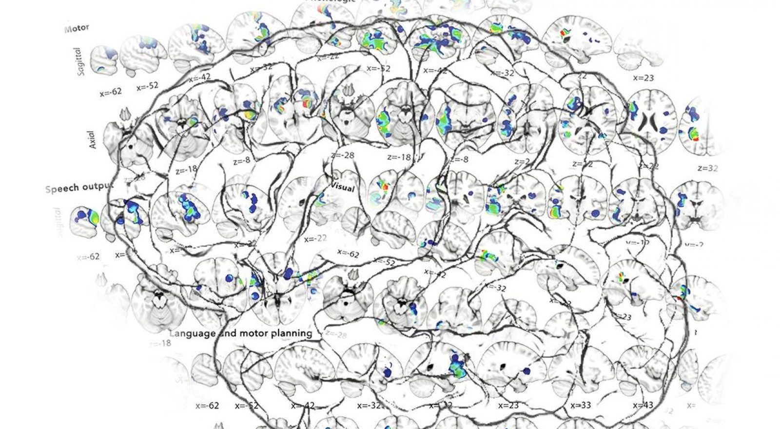 The first functional atlas of the human brain based on intra-operative ...